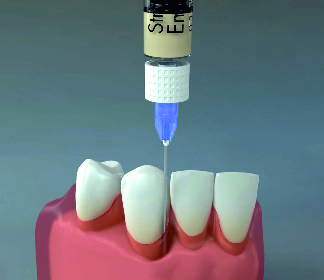 Emdogain® FL: minimalinvasive Parodontalbehandlung